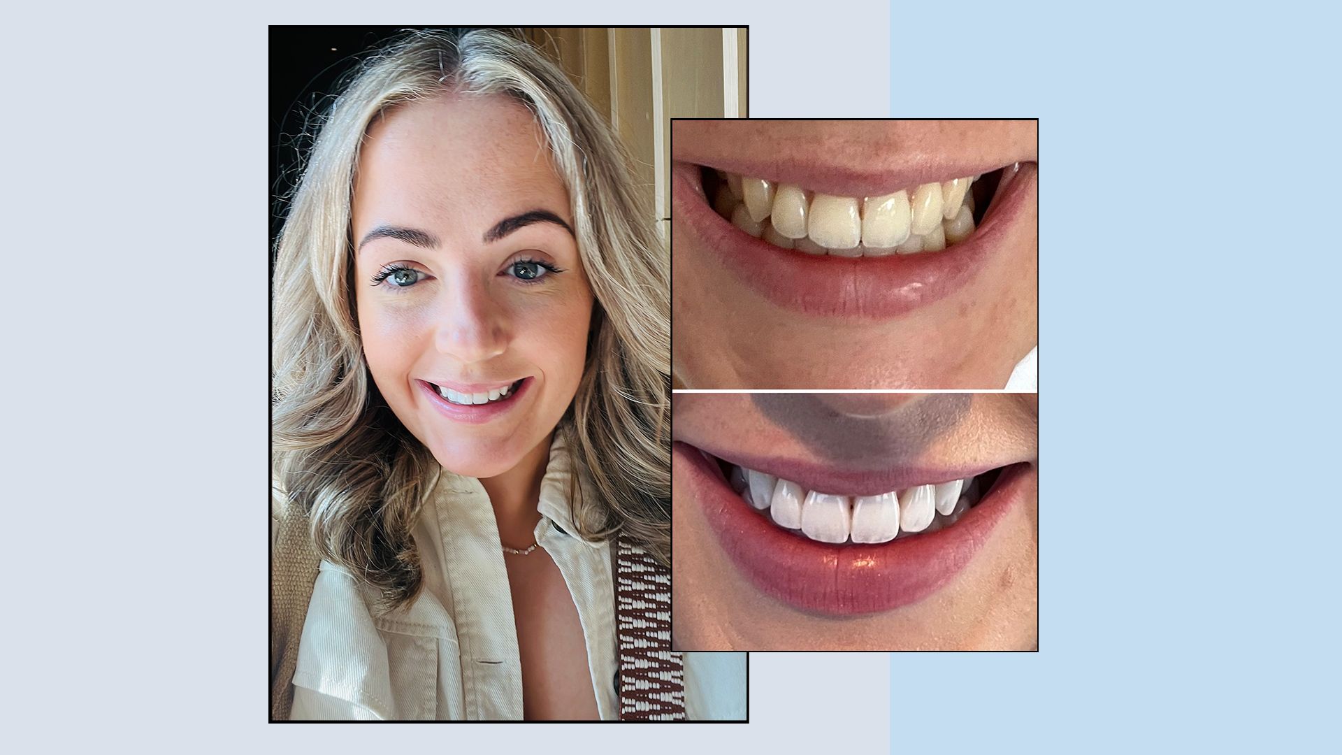 I had a smile makeover – and the results were not what I expected: See ...