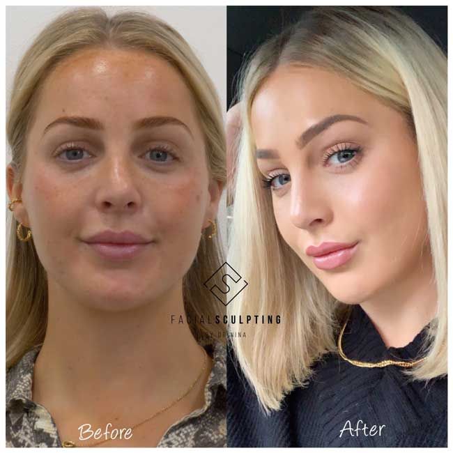 Jawline sculpting before and after: the best treatments for a defined ...