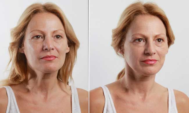 Thread lifts: the non-surgical answer to sculpted cheekbones and a ...