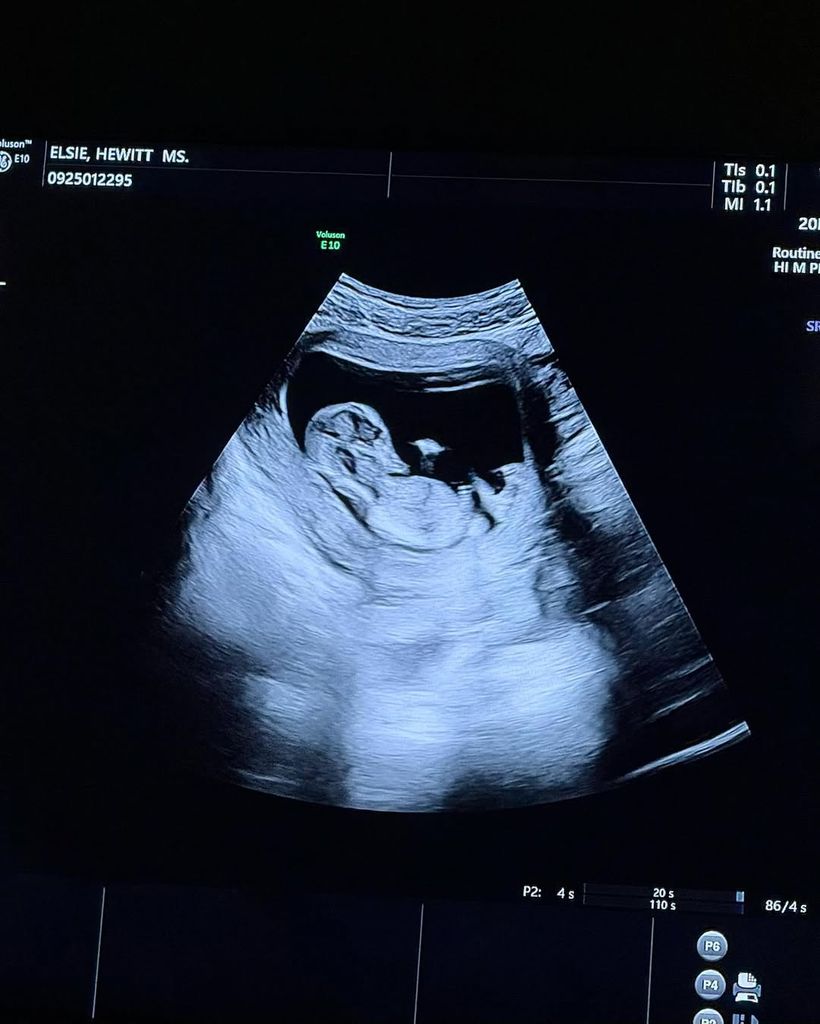 Pete Davidson breaks his silence on becoming a dad | HELLO!