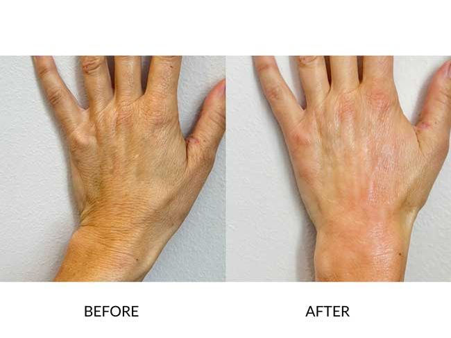 Hand treatments for ageing hands: Age spots, crepey skin and laxity ...
