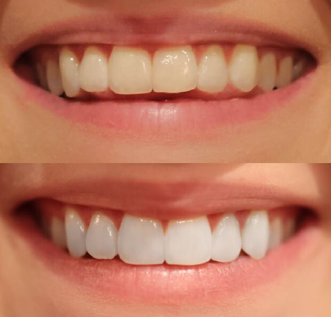 Smile Brilliant's teeth whitening kit has a killer rating in Google's ...