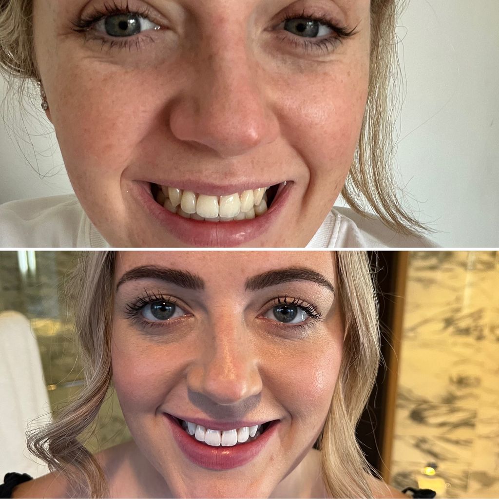 I had a smile makeover – and the results were not what I expected: See ...