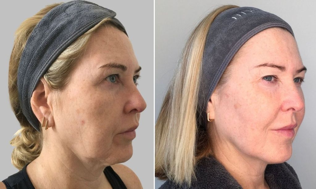 Potenza before and after: I feel comfortable in my skin for the first ...