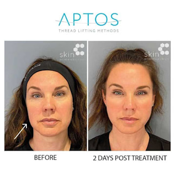Thread lifts: the non-surgical answer to sculpted cheekbones and a ...