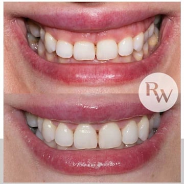 Gum contouring and gum grafts: before and after transformation | HELLO!